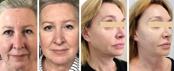 Ultraformer MPT: Exceptional Skin Tightening without surgery